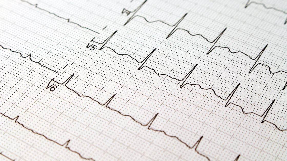 Normal Sleeping Heart Rates
