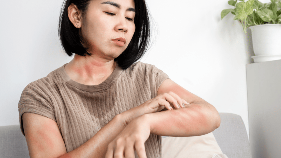 Nighttime Hives: Why They Flare Up and What to Do